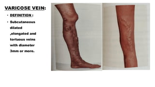 Anatomy of Varicose veins and its management | PDF