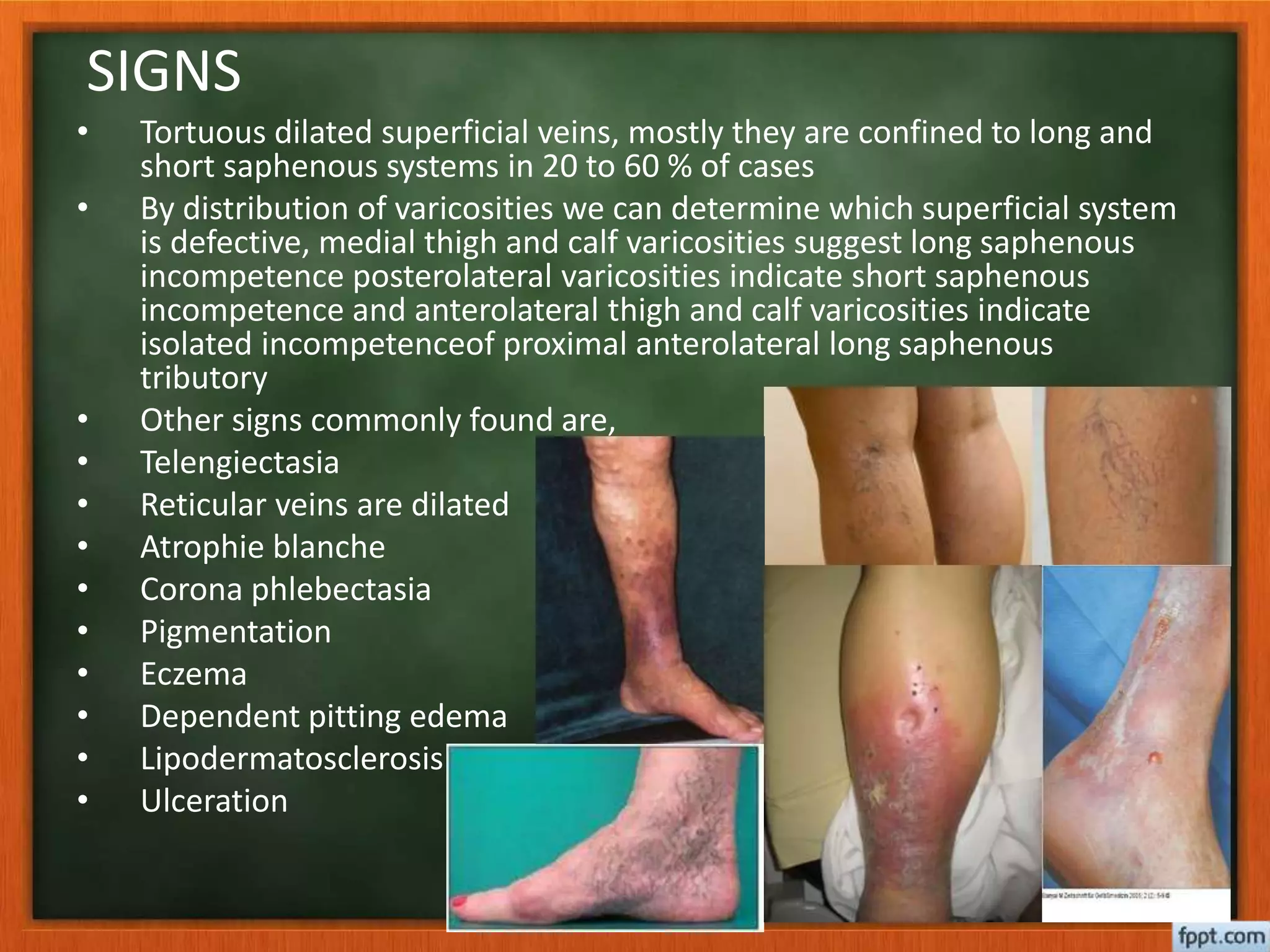 Varicose veins | PPTX