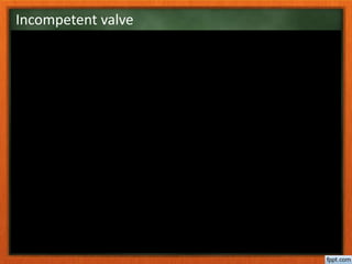 Varicose veins | PPTX