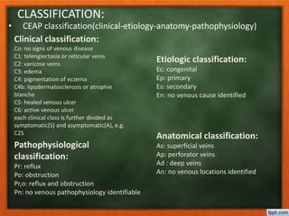 Varicose veins | PPTX