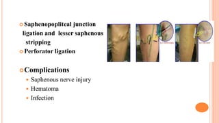 Varicose veins | PPTX