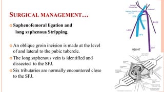 Varicose veins | PPTX