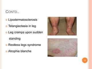 Varicose veins | PPTX