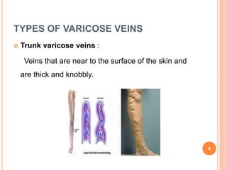 Varicose veins | PPTX