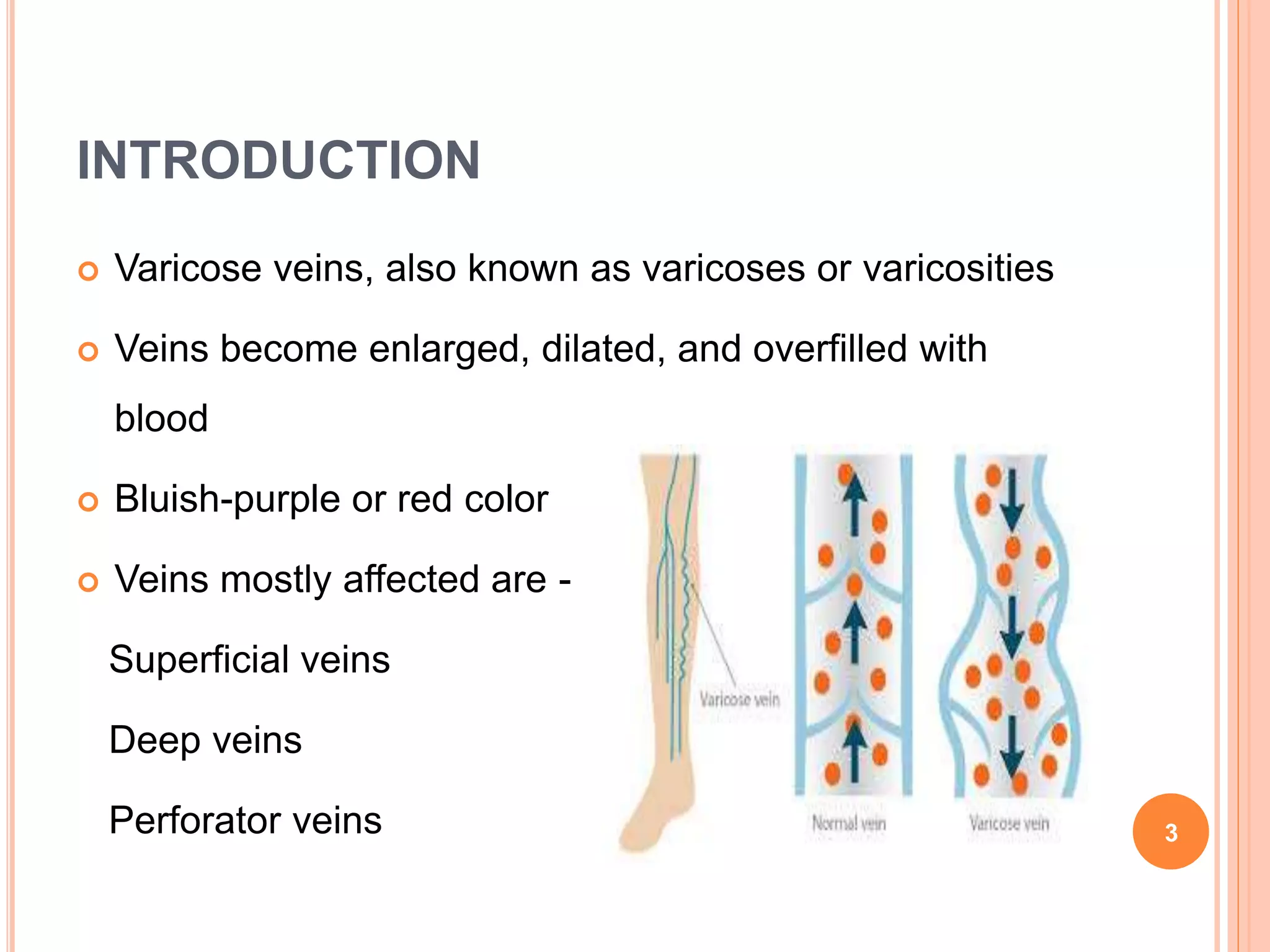 Varicose veins | PPTX