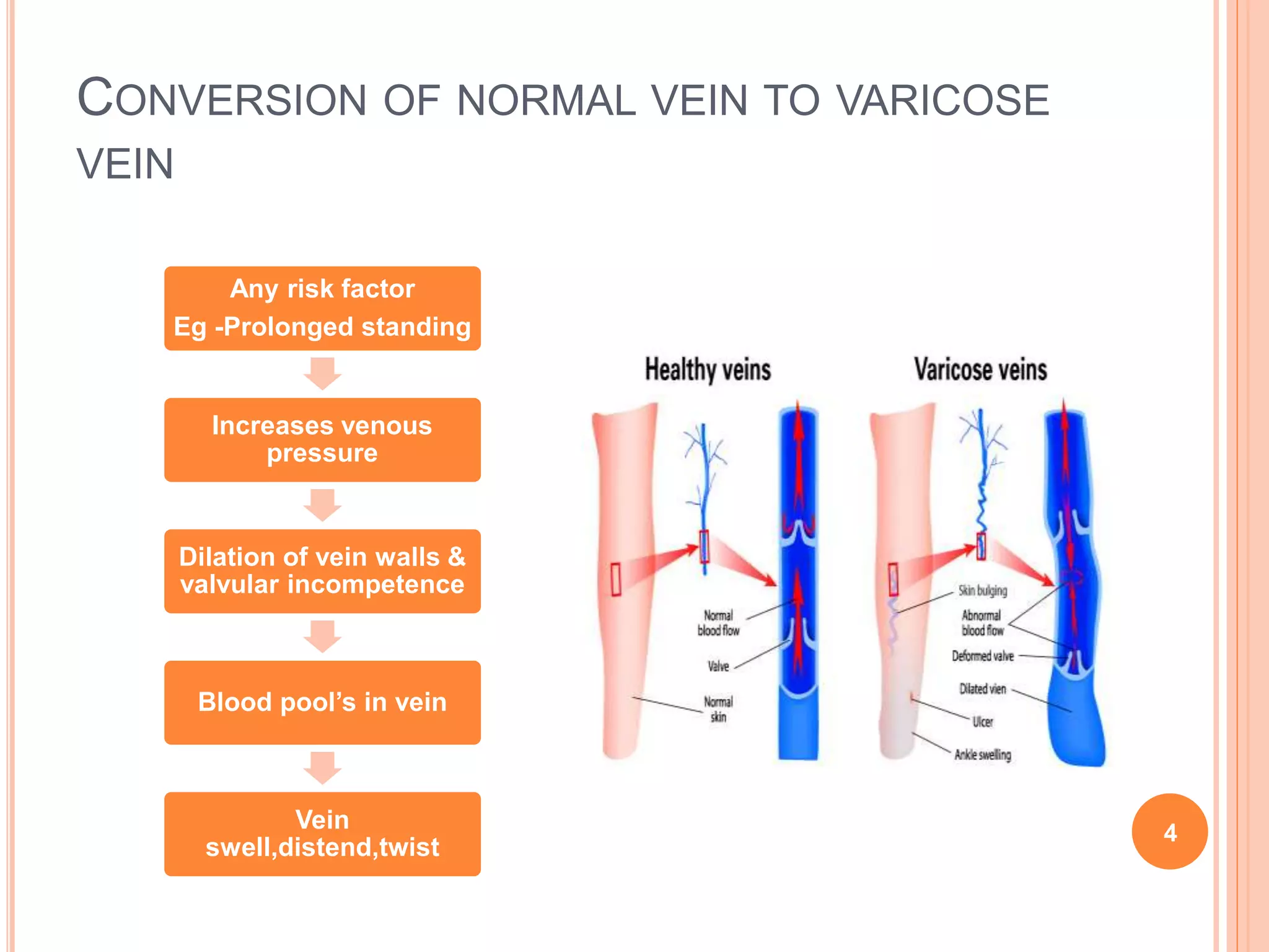 Varicose veins | PPTX