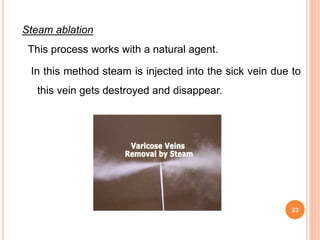 Varicose veins | PPTX