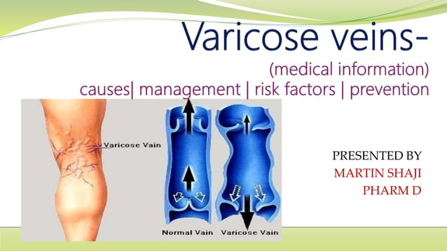 Varicose veins (medical information) causes, manag, risk factors ...