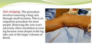 Varicose veins (medical information) causes, manag, risk factors ...