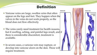 Varicose veins (medical information) causes, manag, risk factors ...