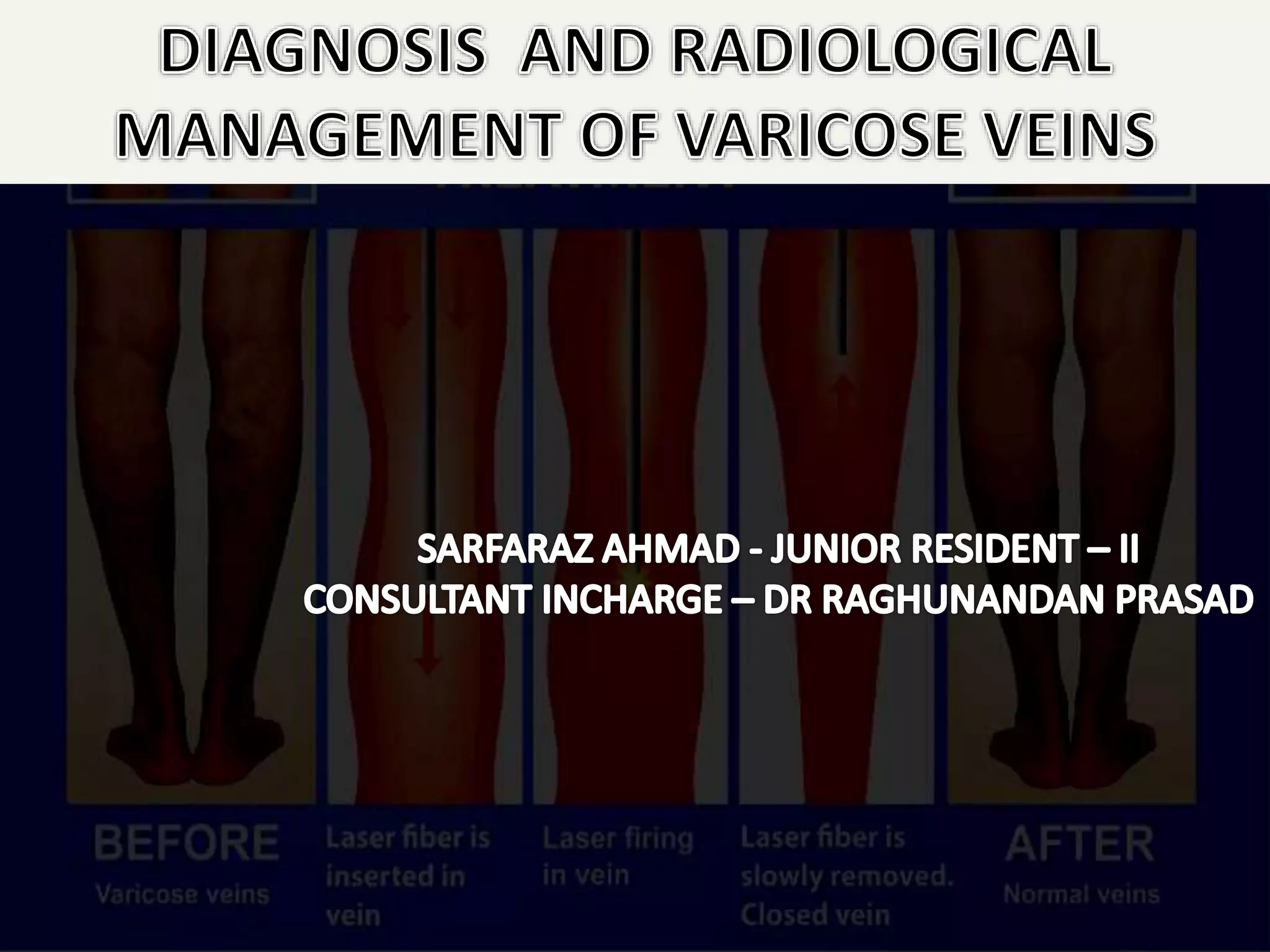 Diagnosis and radiological management of varicose vein | PPTX
