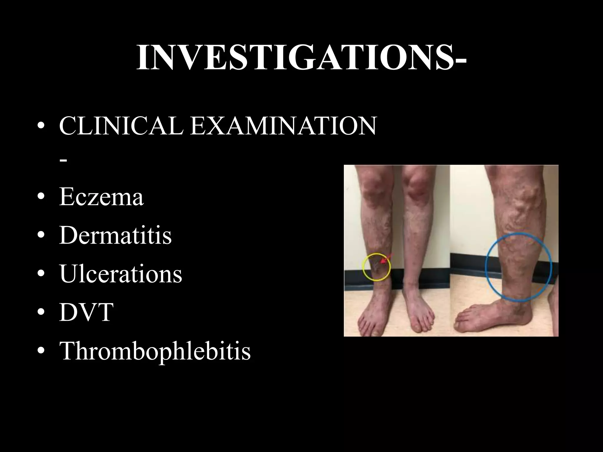 Diagnosis and radiological management of varicose vein | PPTX