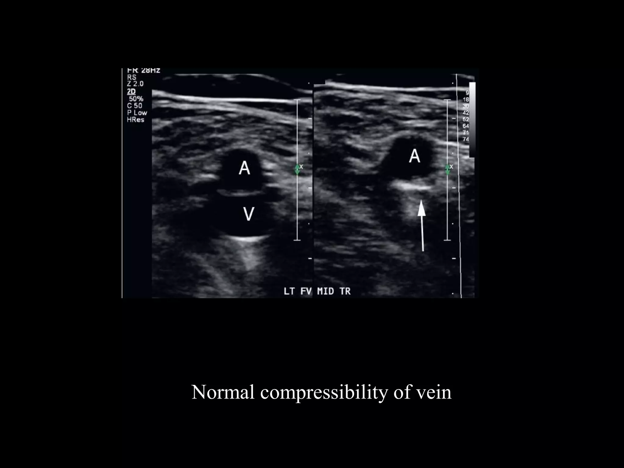 Diagnosis and radiological management of varicose vein | PPTX