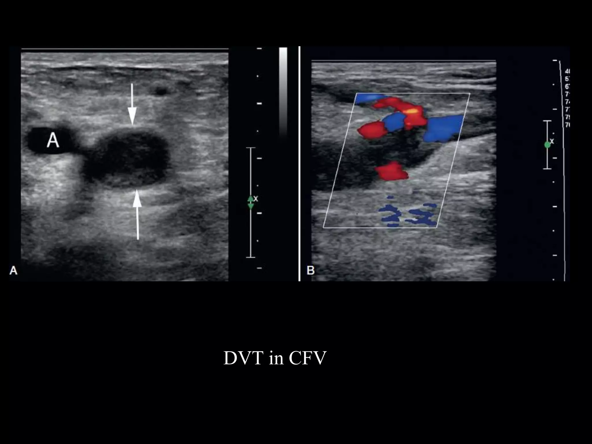 Diagnosis and radiological management of varicose vein | PPTX