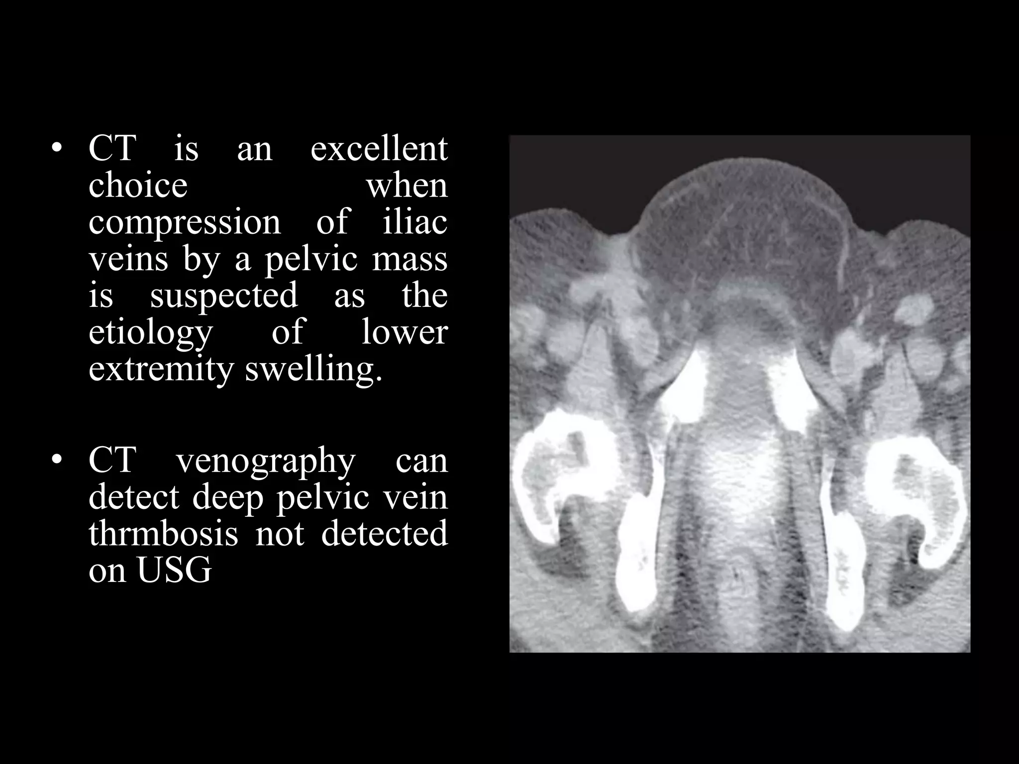 Diagnosis and radiological management of varicose vein | PPTX