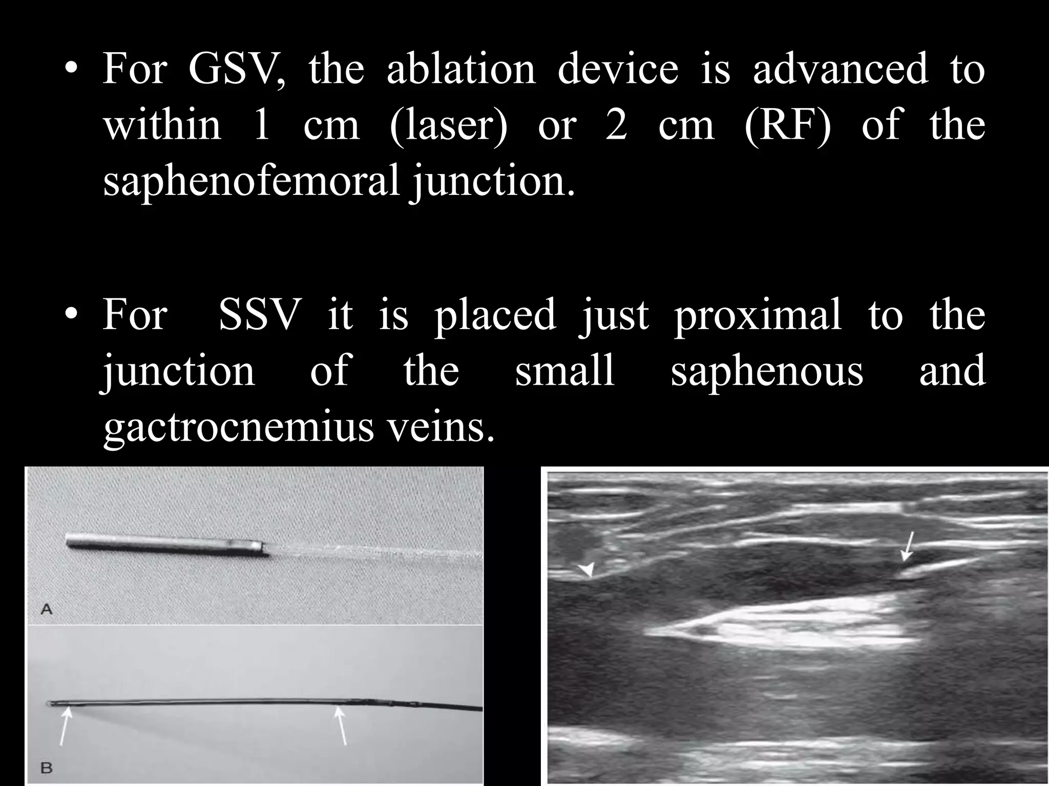 Diagnosis and radiological management of varicose vein | PPTX
