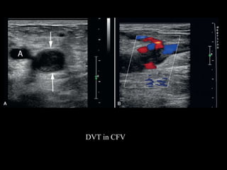 Diagnosis and radiological management of varicose vein | PPTX