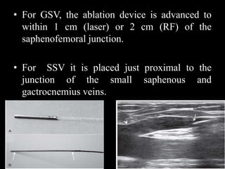 Diagnosis and radiological management of varicose vein | PPTX