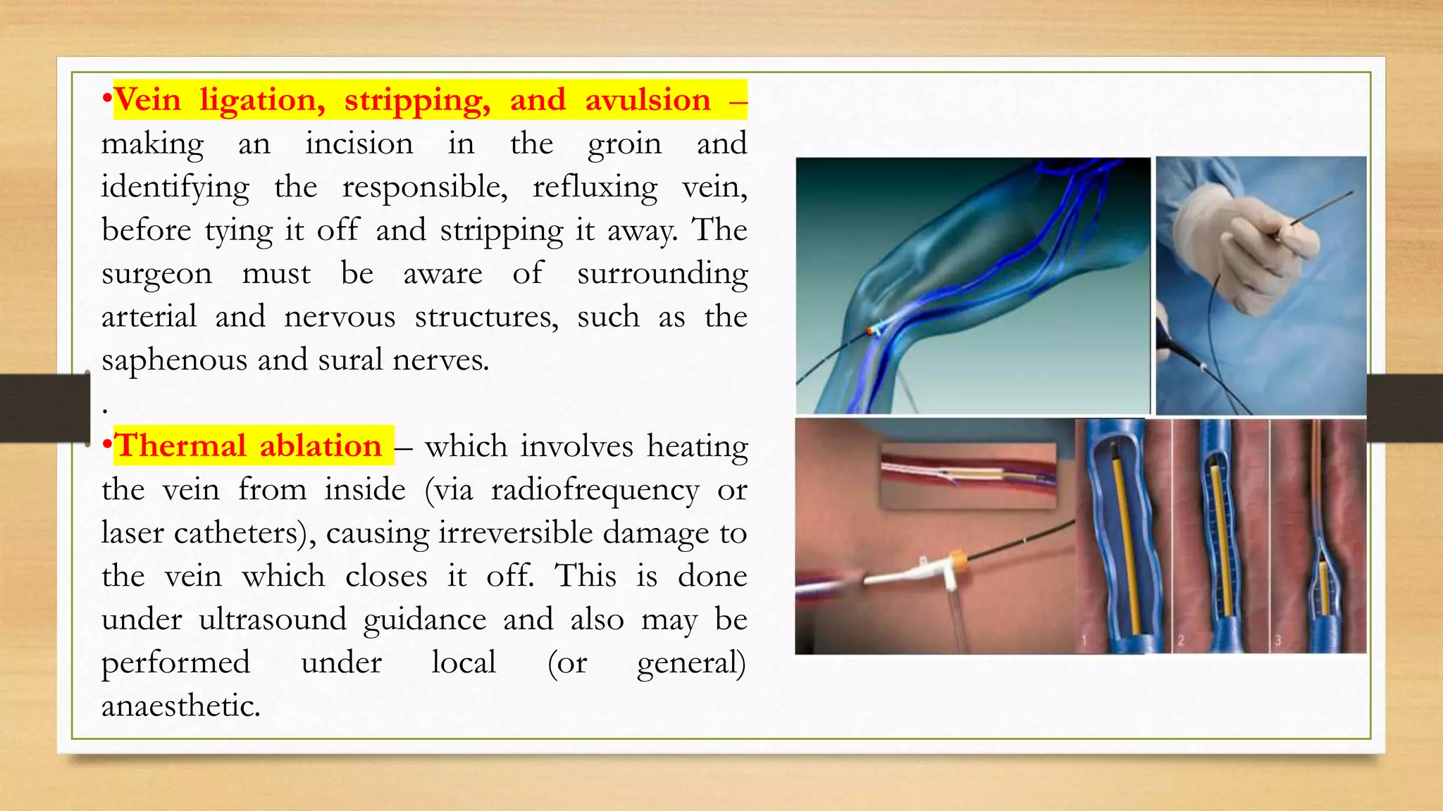 Varicose veins | PPTX