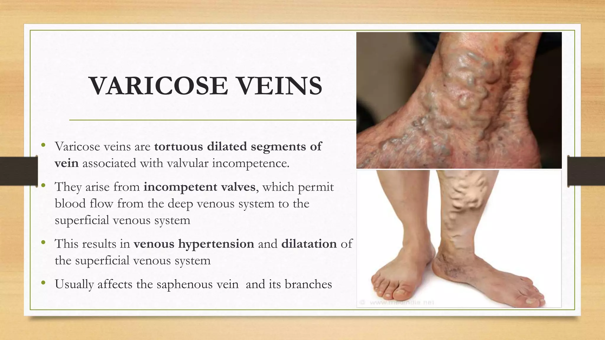 Varicose veins | PPTX