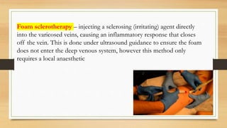 Varicose veins | PPTX