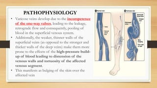 Varicose veins | PPTX