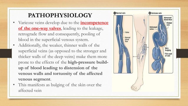 Varicose veins | PPTX