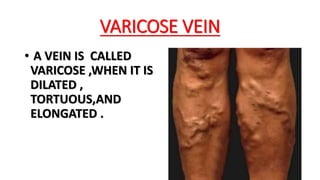 varicose veins.pptx