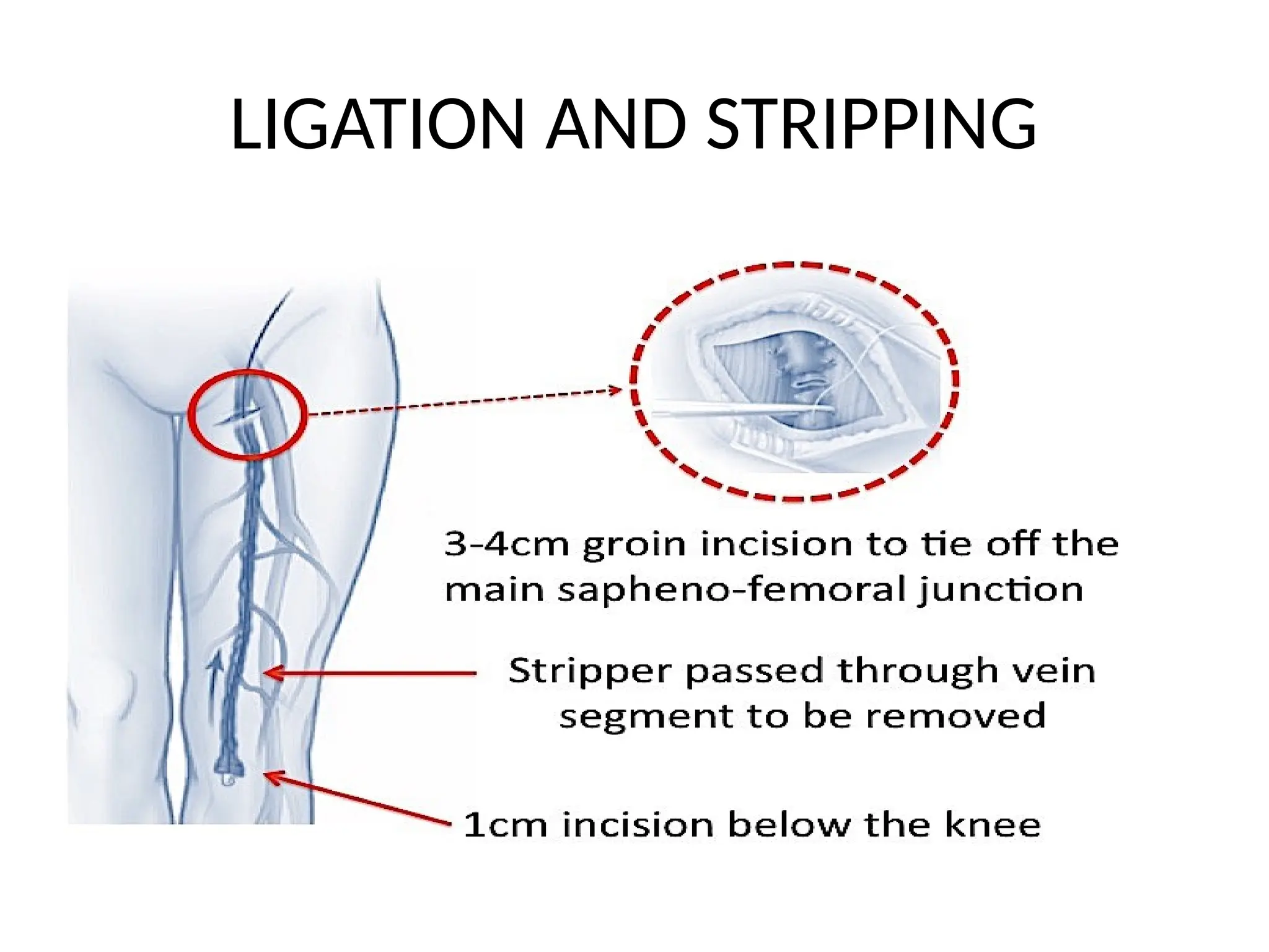 Varicose veins are dilated superficial veins caused by venous hypertension. | PPT