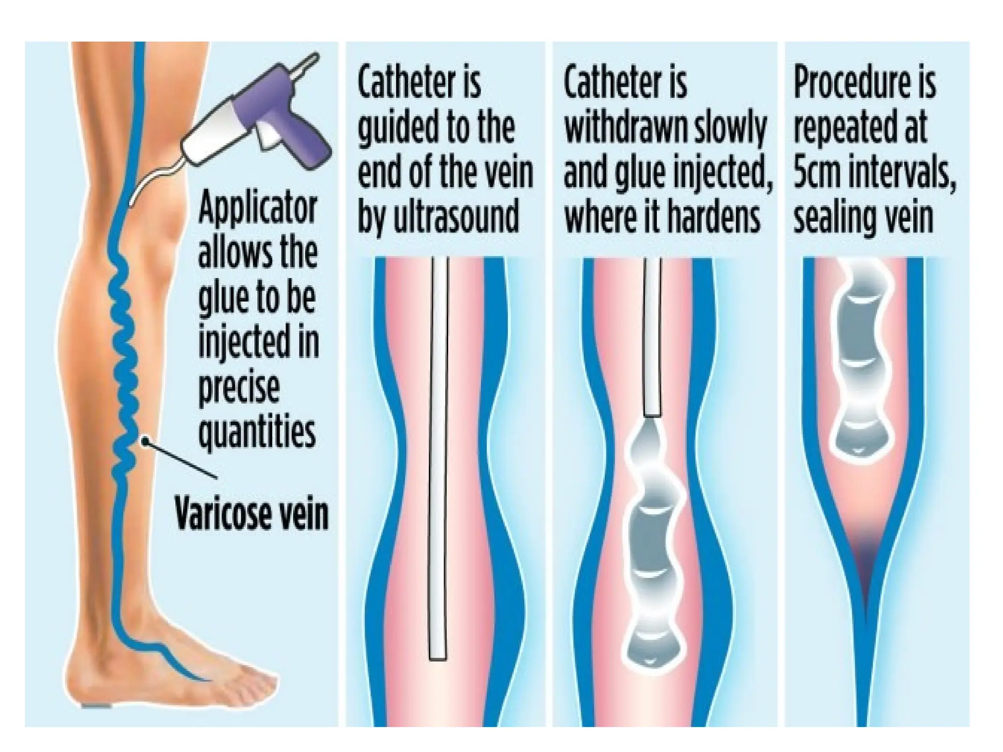 Varicose veins are dilated superficial veins caused by venous hypertension. | PPT