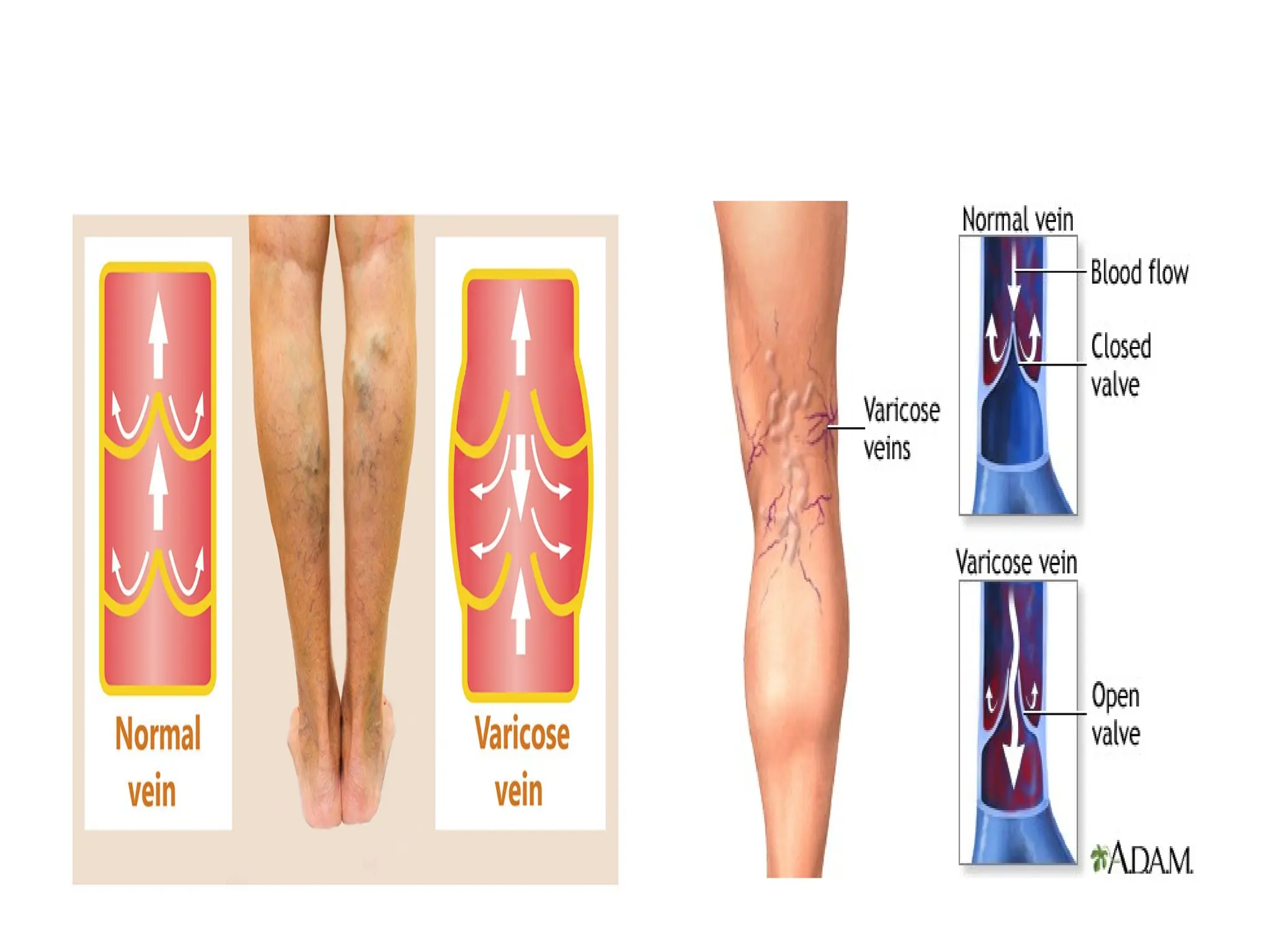 Varicose veins are dilated superficial veins caused by venous hypertension. | PPT