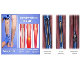 Varicose veins are dilated superficial veins caused by venous hypertension. | PPT
