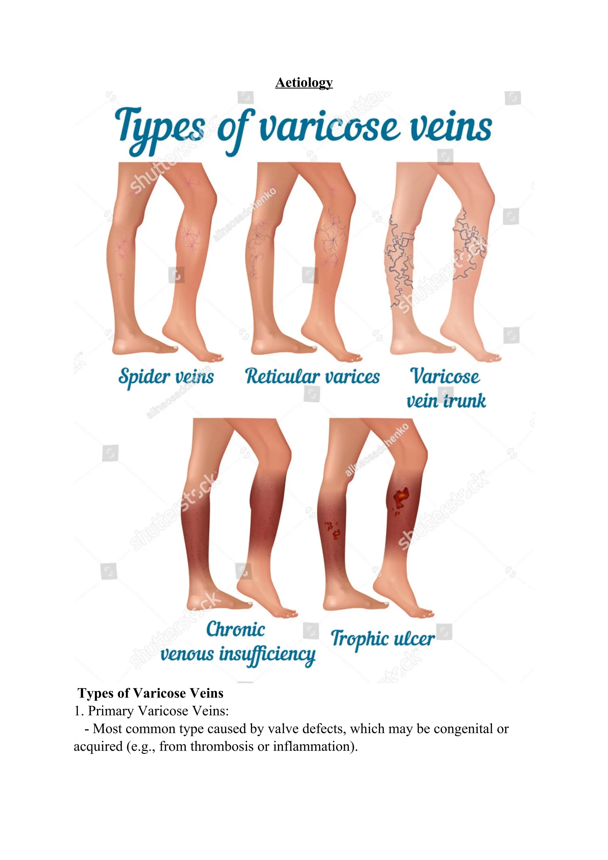 varicose veins and PVD (Peripheral Vascular Diseases) | DOCX
