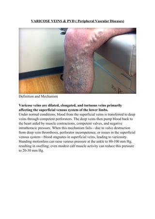 varicose veins and PVD (Peripheral Vascular Diseases) | DOCX