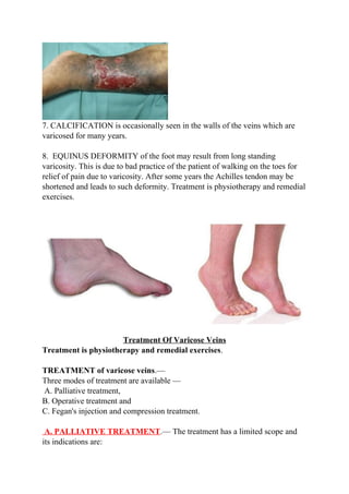 varicose veins and PVD (Peripheral Vascular Diseases) | DOCX