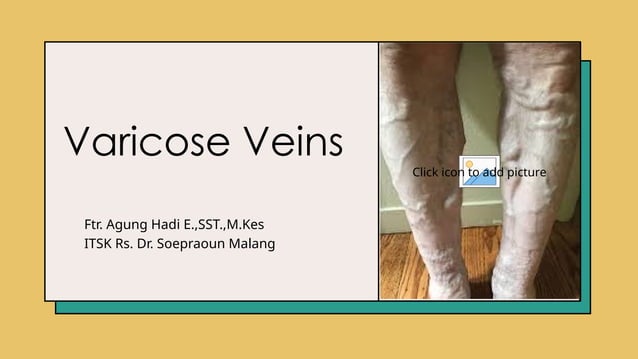 Chronic venous insufficiency (CVI) /Varicose Veins | PPTX