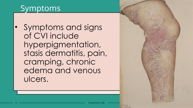 Chronic venous insufficiency (CVI) /Varicose Veins | PPTX