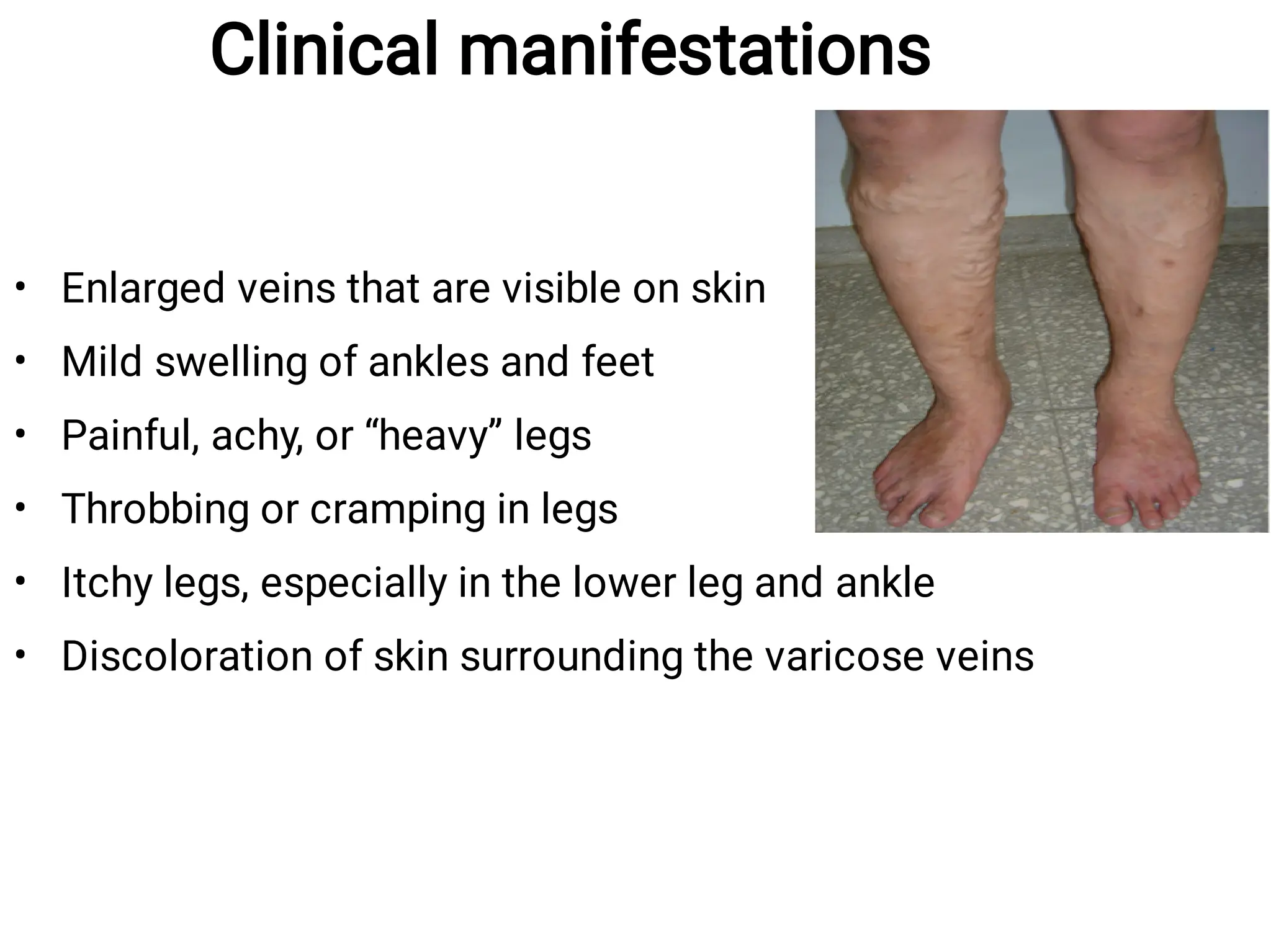 VARICOSE VEINS direct slides ppt lecture hall | PDF
