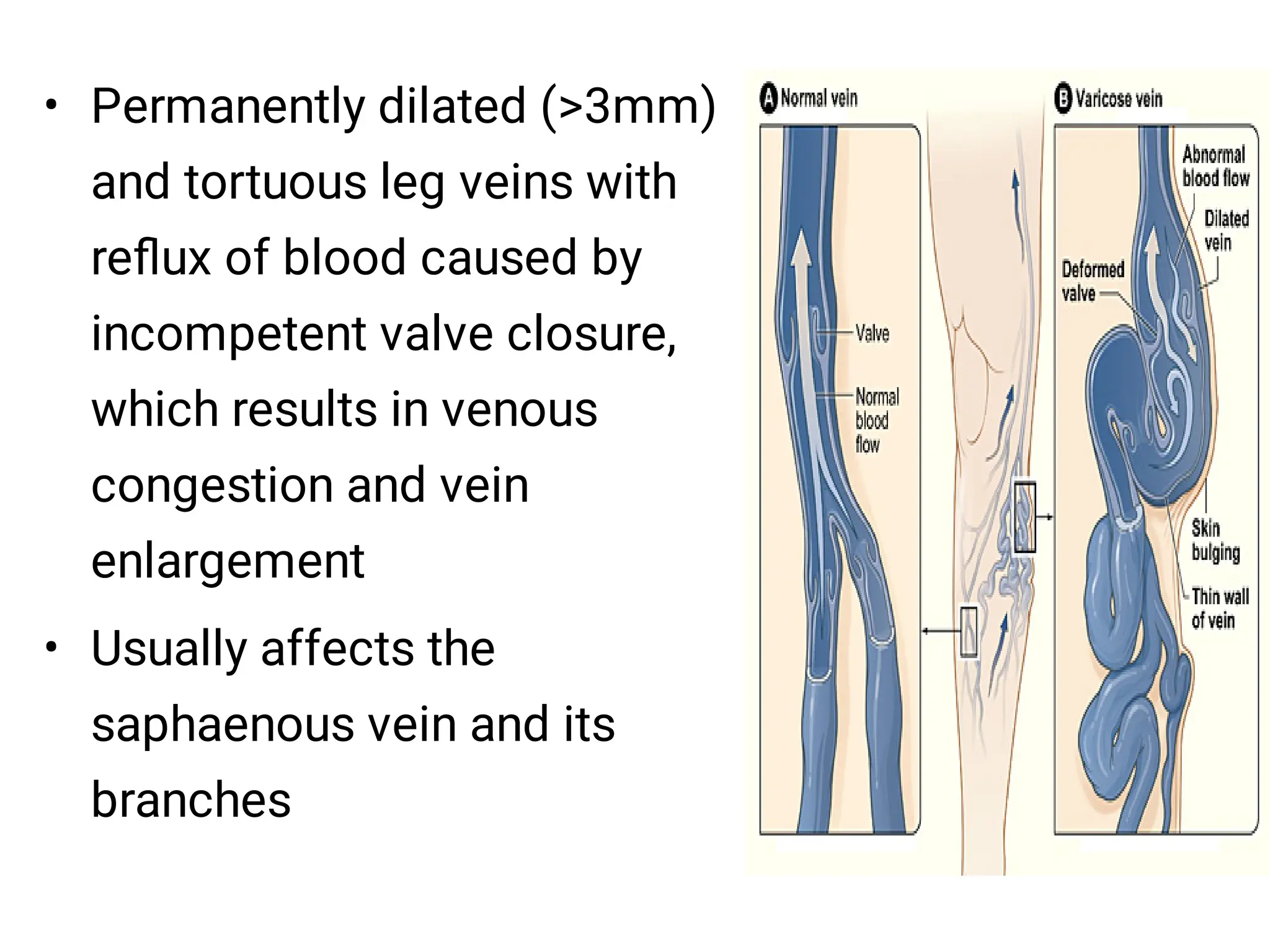VARICOSE VEINS direct slides ppt lecture hall | PDF