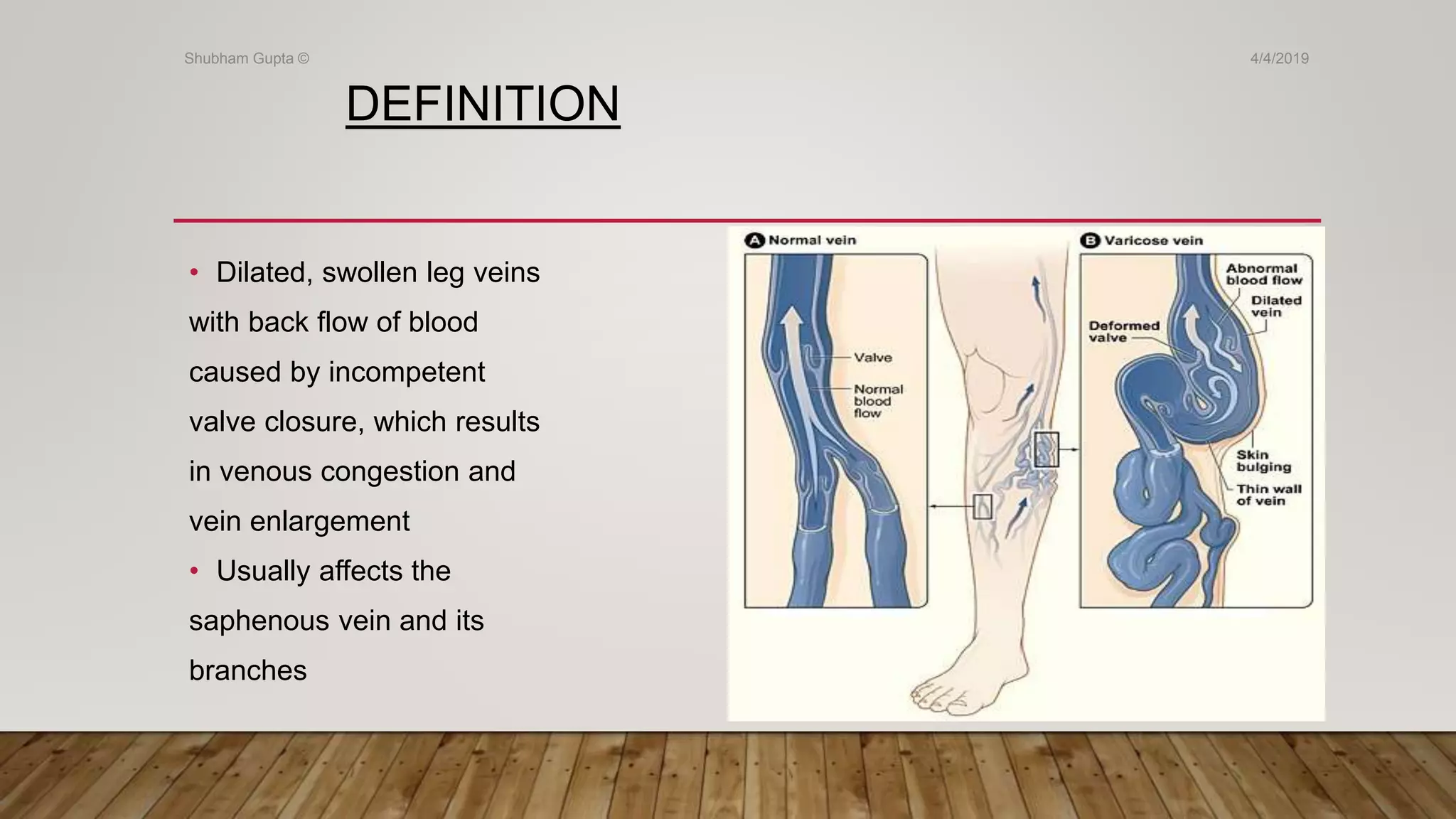 Varicose veins | PPTX