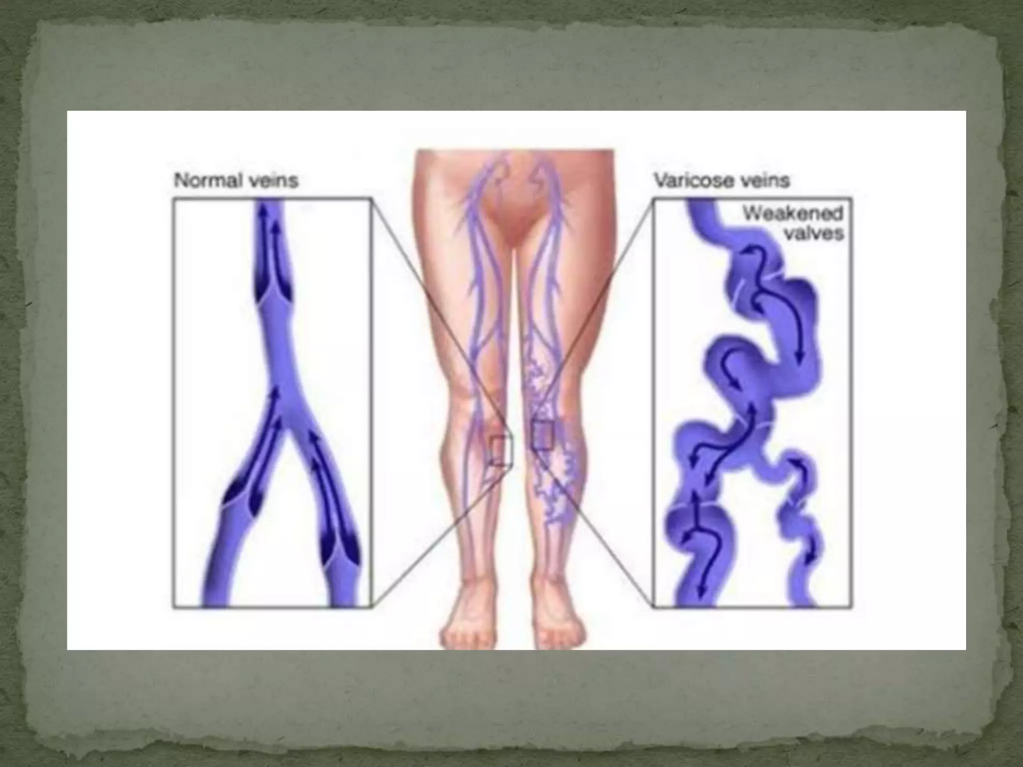 VARICOSE__VEINS Akash Rathod.pptx