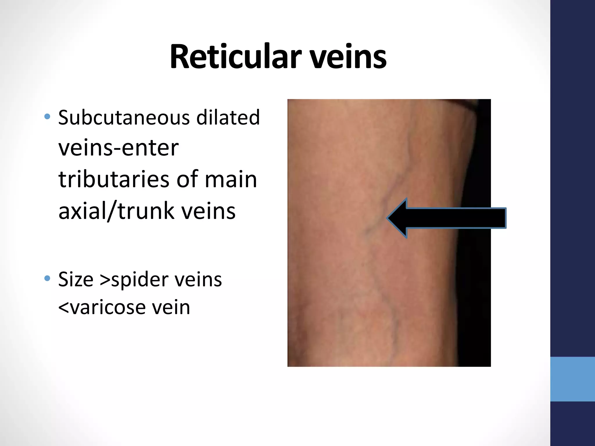 Varicose veins by M.Fathy Zaidan | PPTX