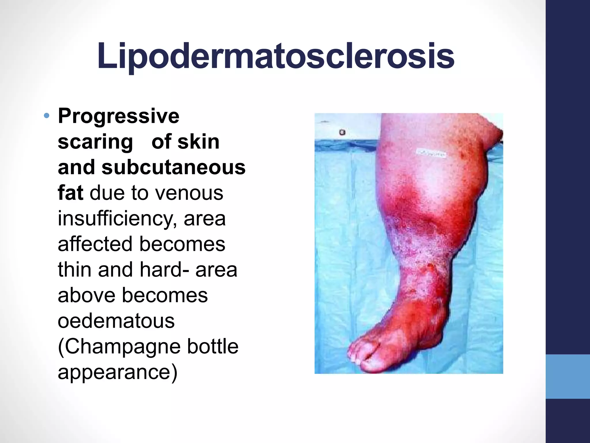 Varicose veins by M.Fathy Zaidan | PPTX