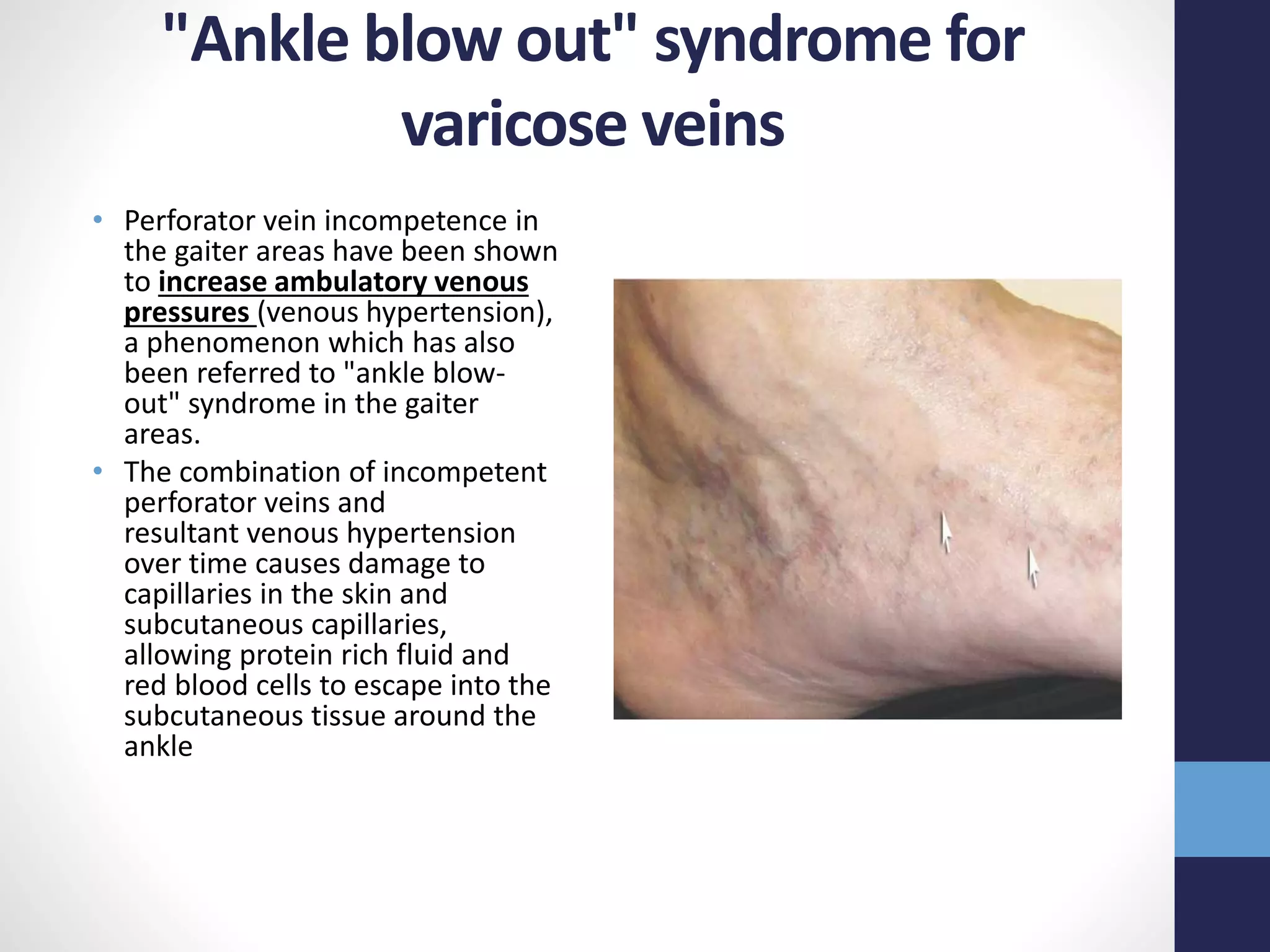 Varicose veins by M.Fathy Zaidan | PPTX