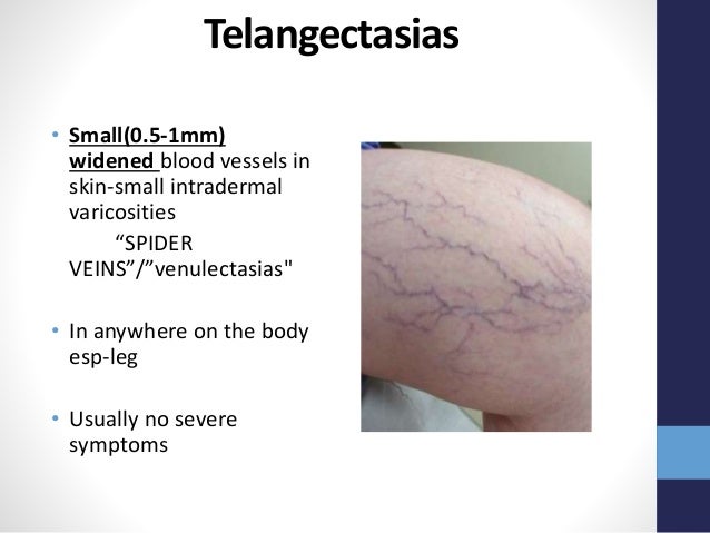 Varicose veins by M.Fathy Zaidan