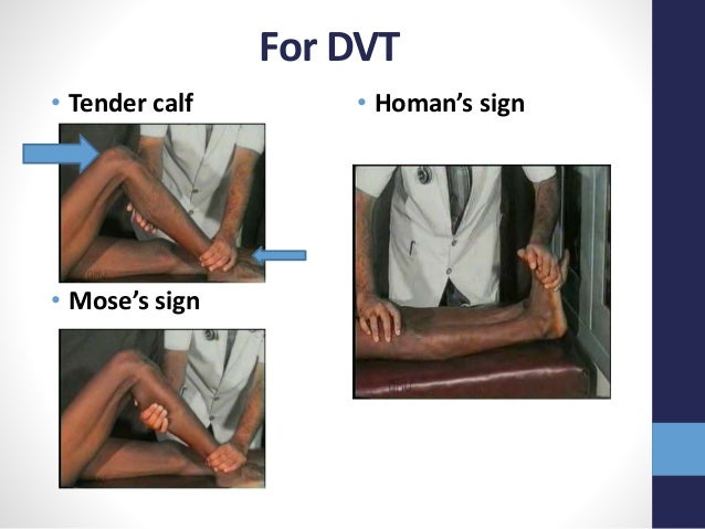 Varicose veins by M.Fathy Zaidan