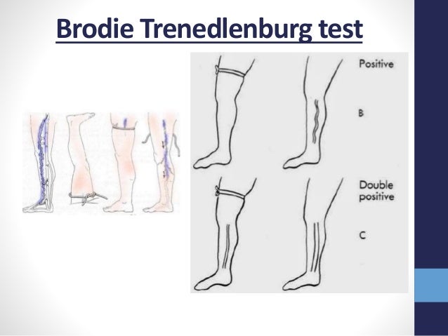 Varicose veins by M.Fathy Zaidan