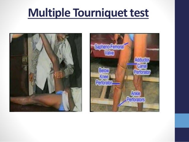 Varicose veins by M.Fathy Zaidan