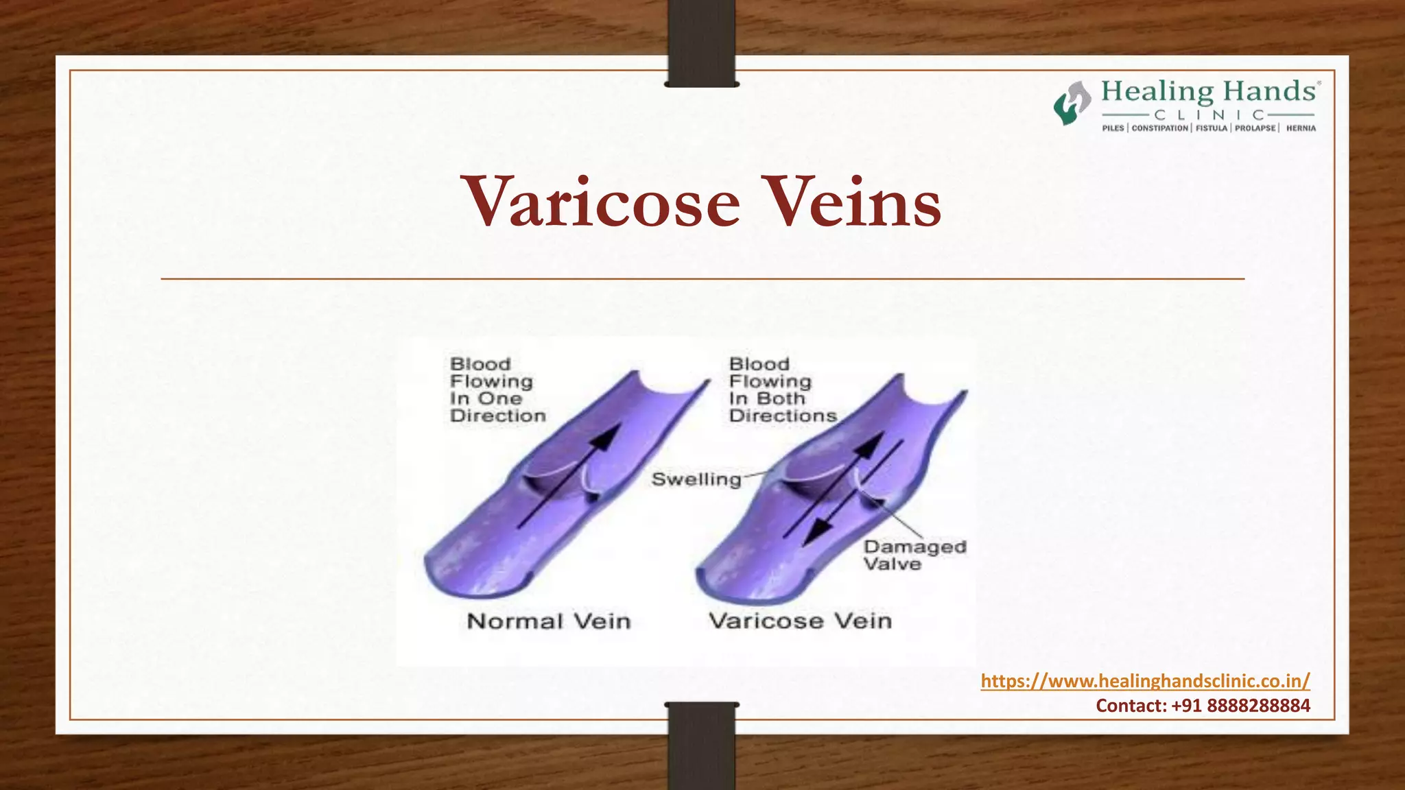 Varicose Veins – Causes and Prevention Methods | PPTX
