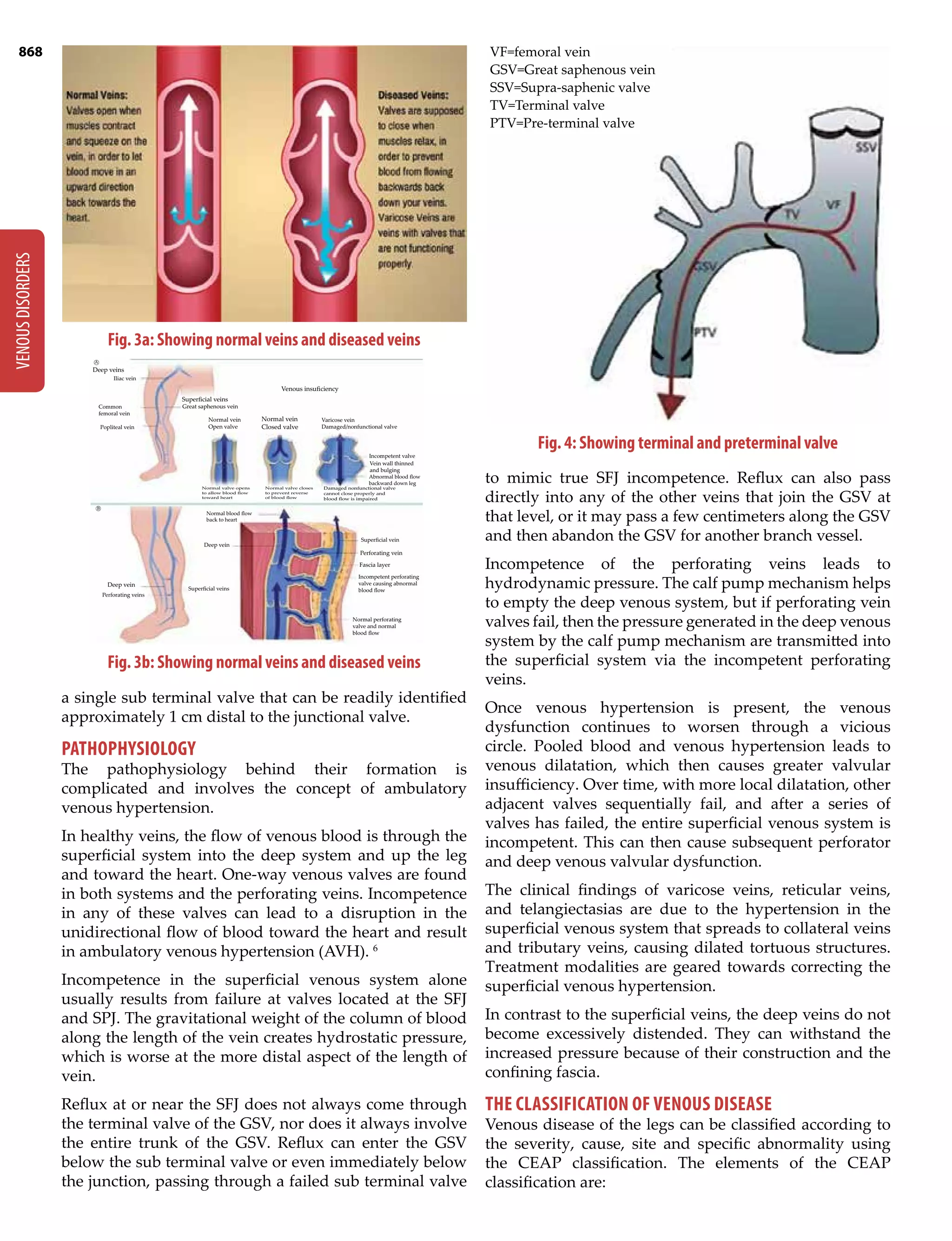 Anatomy, Physiology & Classification of Varicose Veins | PDF